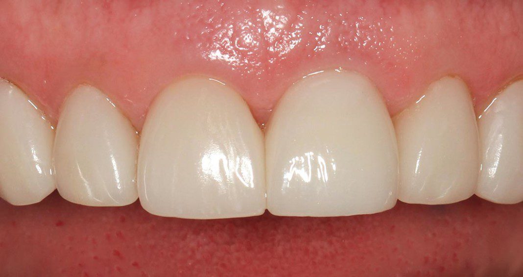 Front Implant Crown – Left Central Incisor- Fractured Tooth (Female ...