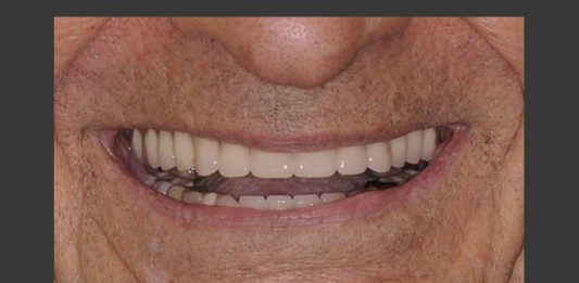 Implant Partial Dentures - Dental Implant Center