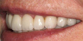 Full Mouth Crowns - Dental Implant Center