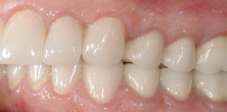 Full Mouth Crowns - Dental Implant Center