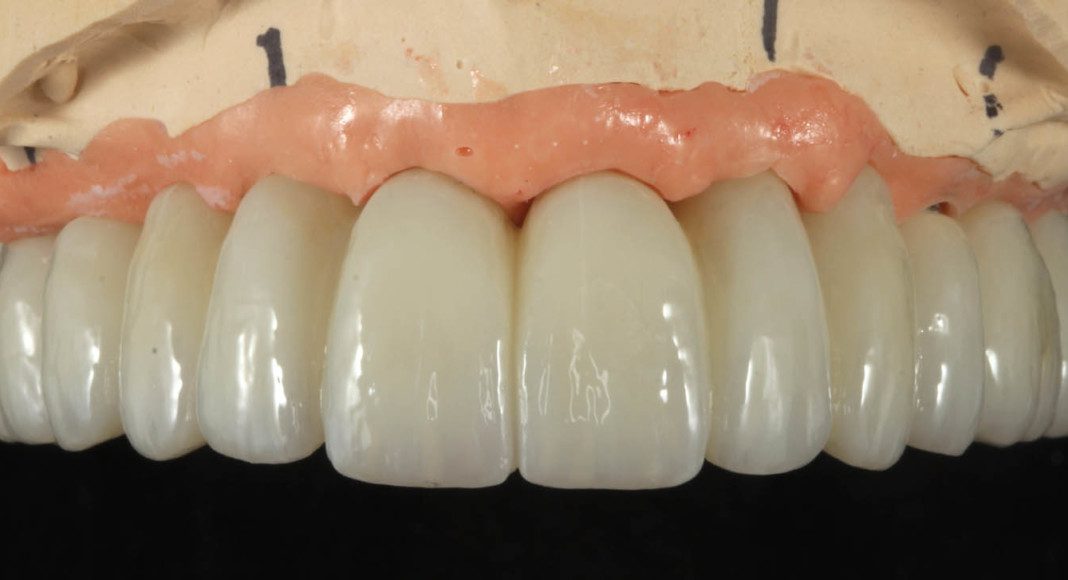 Upper Fixed Implant Bridges – Transitional Treatment (Female)