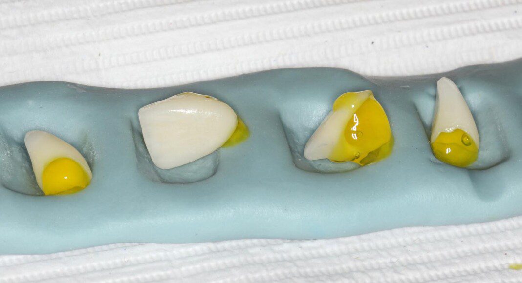 Full Mouth Porcelain Crowns - Grinder - Staged (Male) - Dental Implant ...