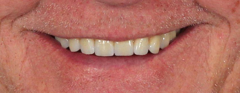 Do Dental Implants Look Like Natural Teeth? - Dental Implant Center