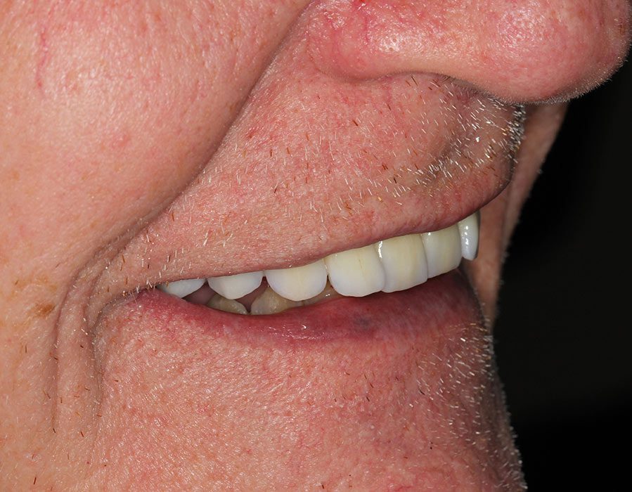Do Dental Implants Look Like Natural Teeth? - Dental Implant Center