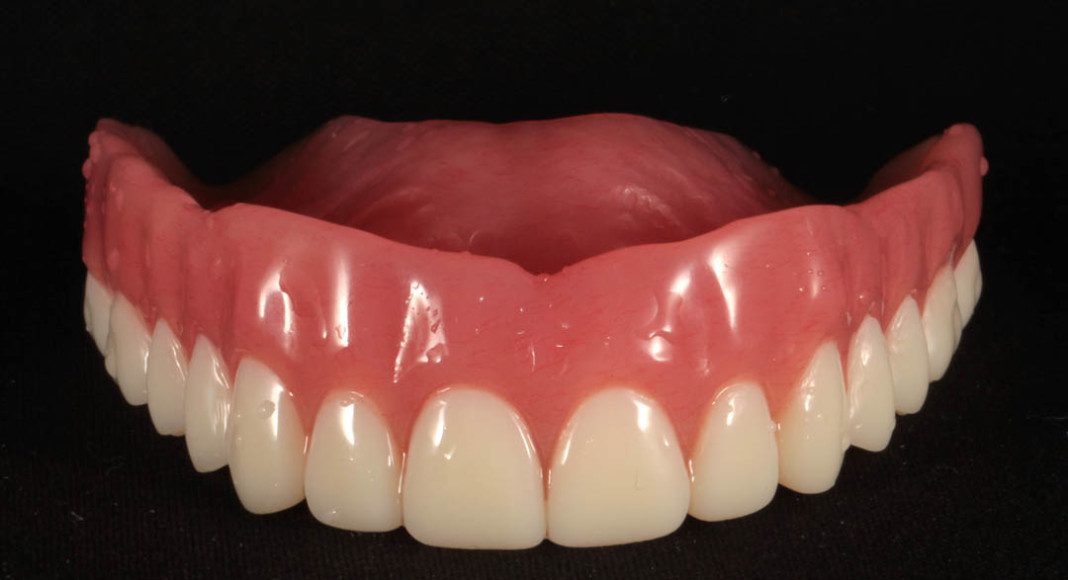Upper and Lower Implant Overdentures - 9 total implants (Male)