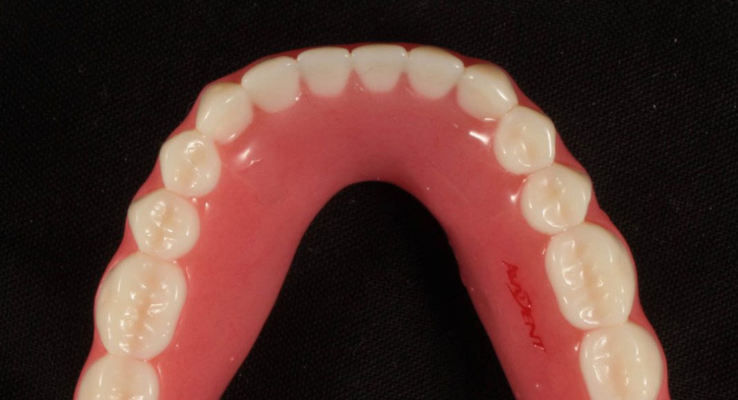 Upper and Lower Implant Overdentures - 9 total implants (Male)