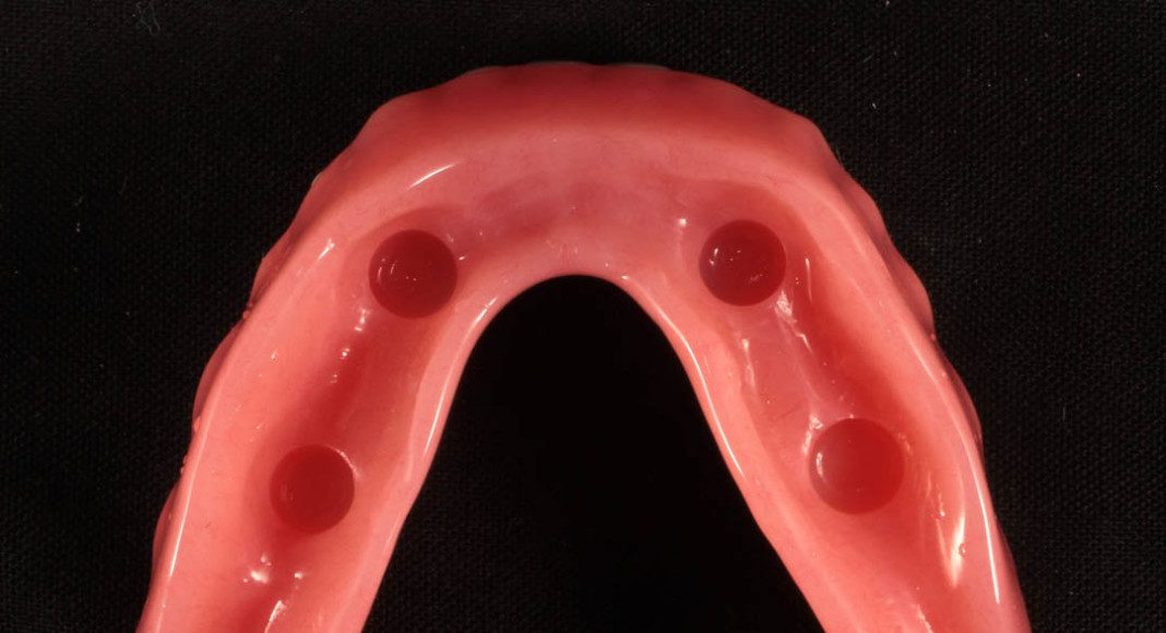 Upper and Lower Implant Overdentures - 9 total implants (Male)