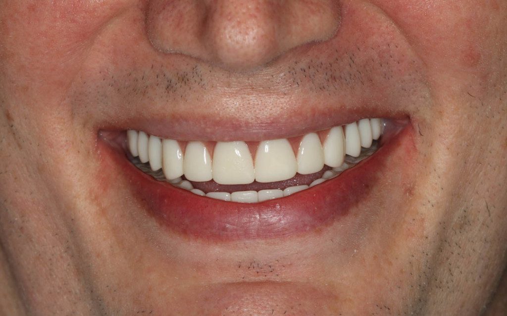 Upper and Lower Implant Overdentures - 9 total implants (Male)