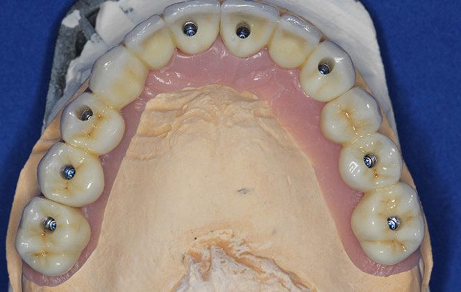Upper Fixed Implant Bridges, Lower Titanium/Acrylic Hybrid (All-on-4 ...