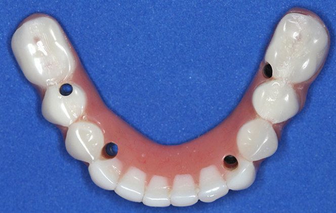 Upper Fixed Implant Bridges, Lower Titanium/Acrylic Hybrid (All-on-4 ...