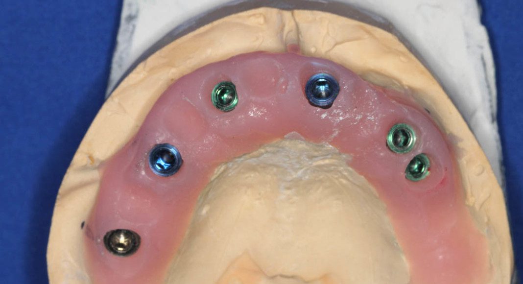 Upper Fixed Implant Bridges – Transitional Treatment (Female) - Dental ...