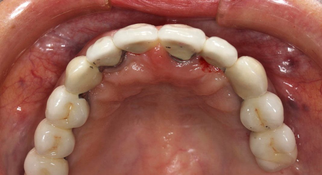 Upper Fixed Implant Bridges – Transitional Treatment (Female) - Dental ...