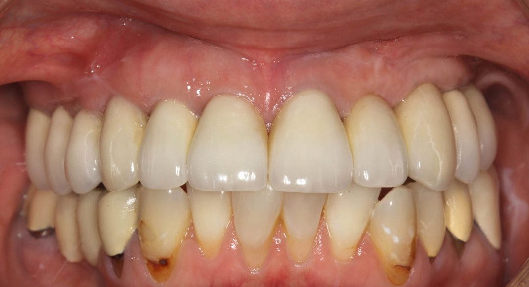 Upper Fixed Implant Bridges – Transitional Treatment (Female) - Dental ...