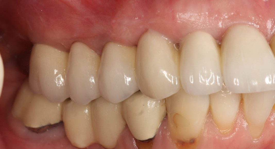 Upper Fixed Implant Bridges – Transitional Treatment (Female) - Dental ...