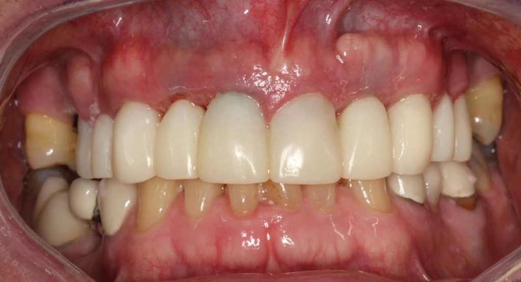 Upper Fixed Implant Crowns and Tooth Crowns (Metal/Ceramic) – (Upper ...