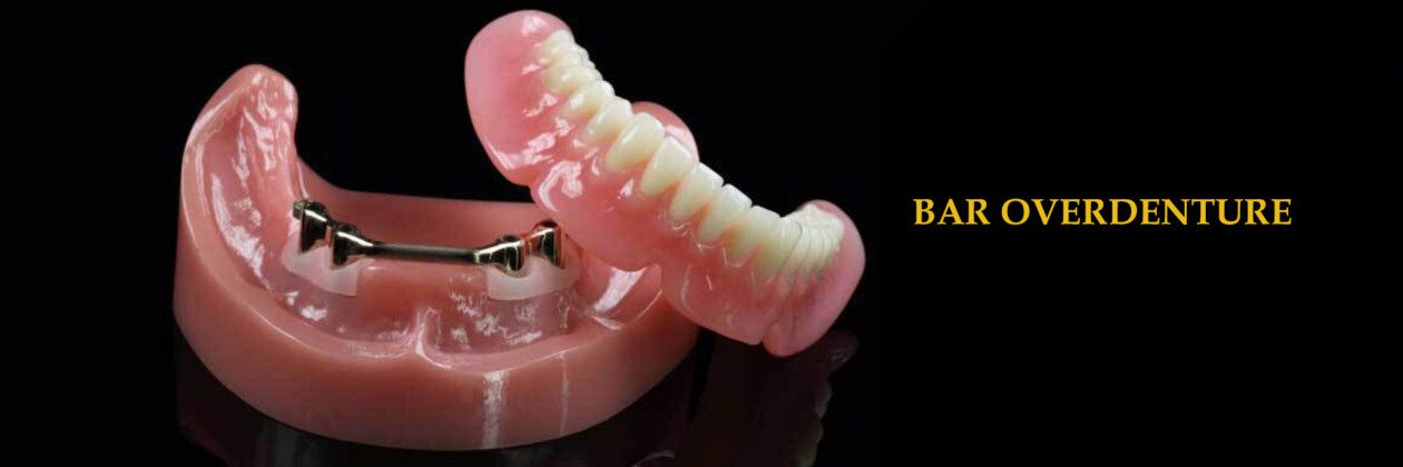Removable Implant Dentures/Overdentures - Dental Implants