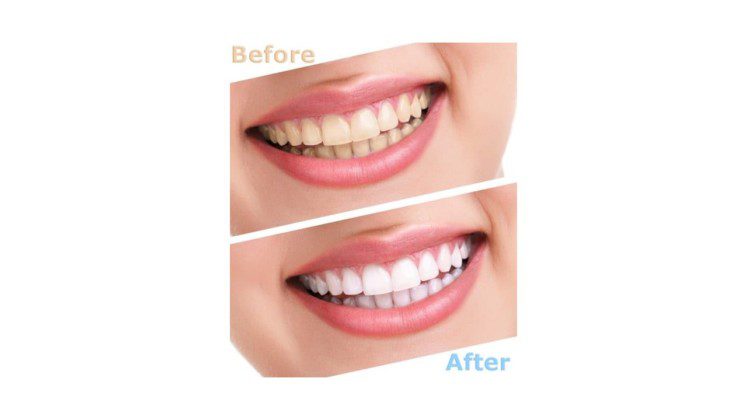 Teeth Whitening: A Review of the Options - Dental Implant Center