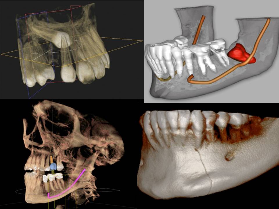 Cone Beam CT Scans - Dental Implant Center