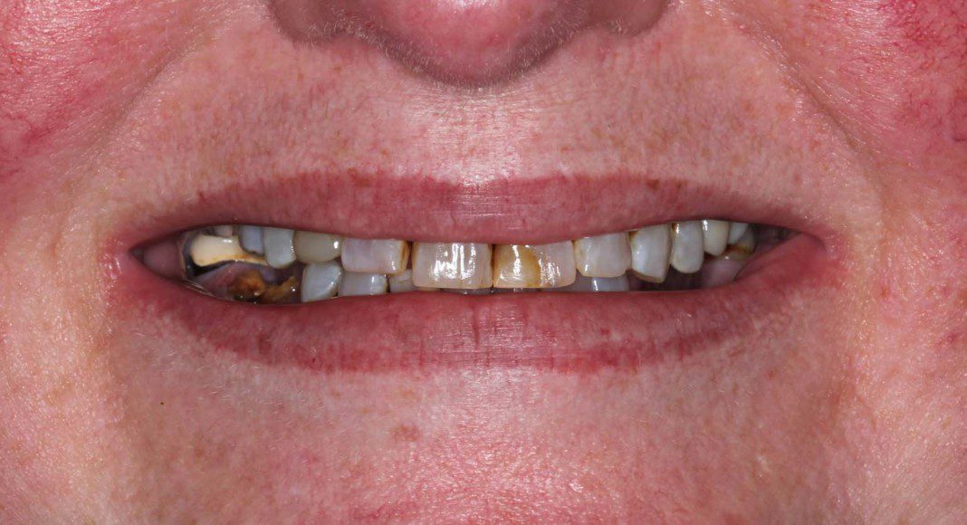 Upper and Lower Fixed Implant Bridges – Transitional Treatment (Female ...