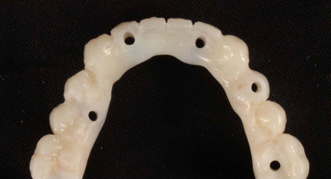 Upper and Lower Fixed Implant Bridges – Transitional Treatment (Female ...