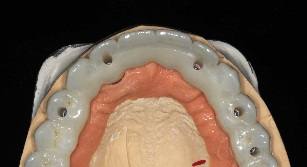 Upper and Lower Fixed Implant Bridges – Transitional Treatment (Female ...