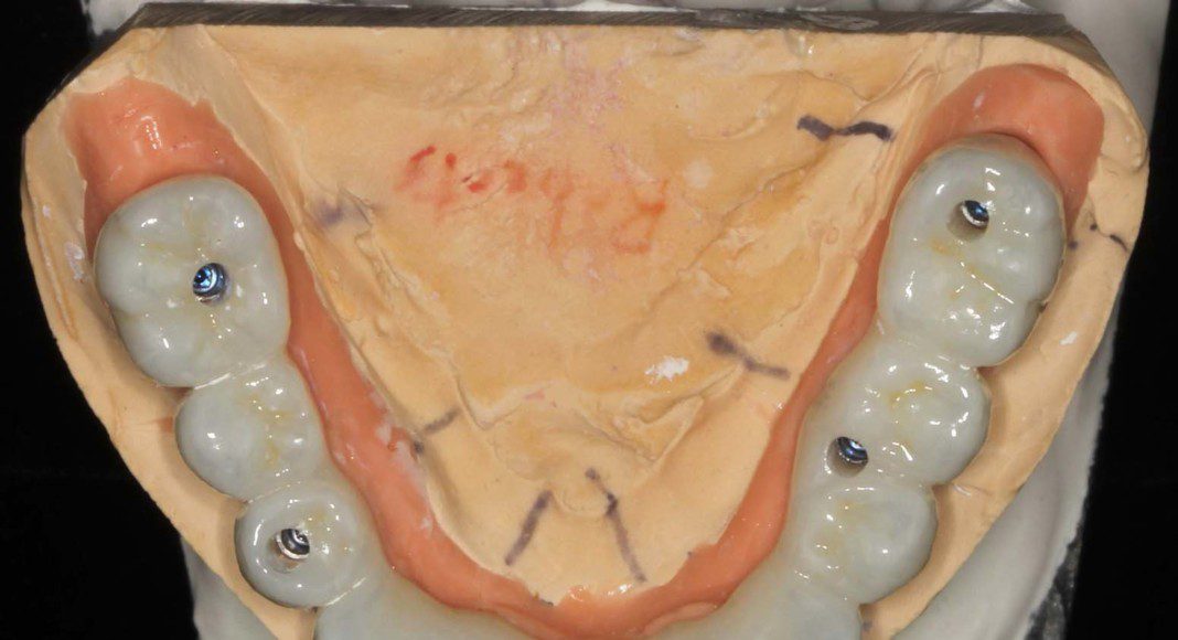 Upper and Lower Fixed Implant Bridges – Transitional Treatment (Female ...