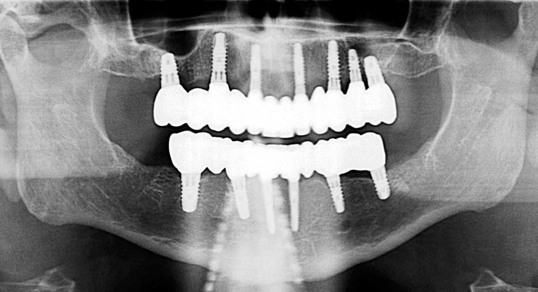 Upper and Lower Fixed Implant Bridges – Transitional Treatment (Female ...