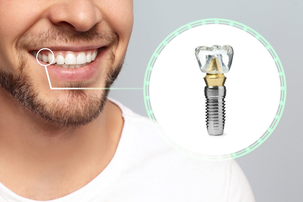 Dental Implants Benefits