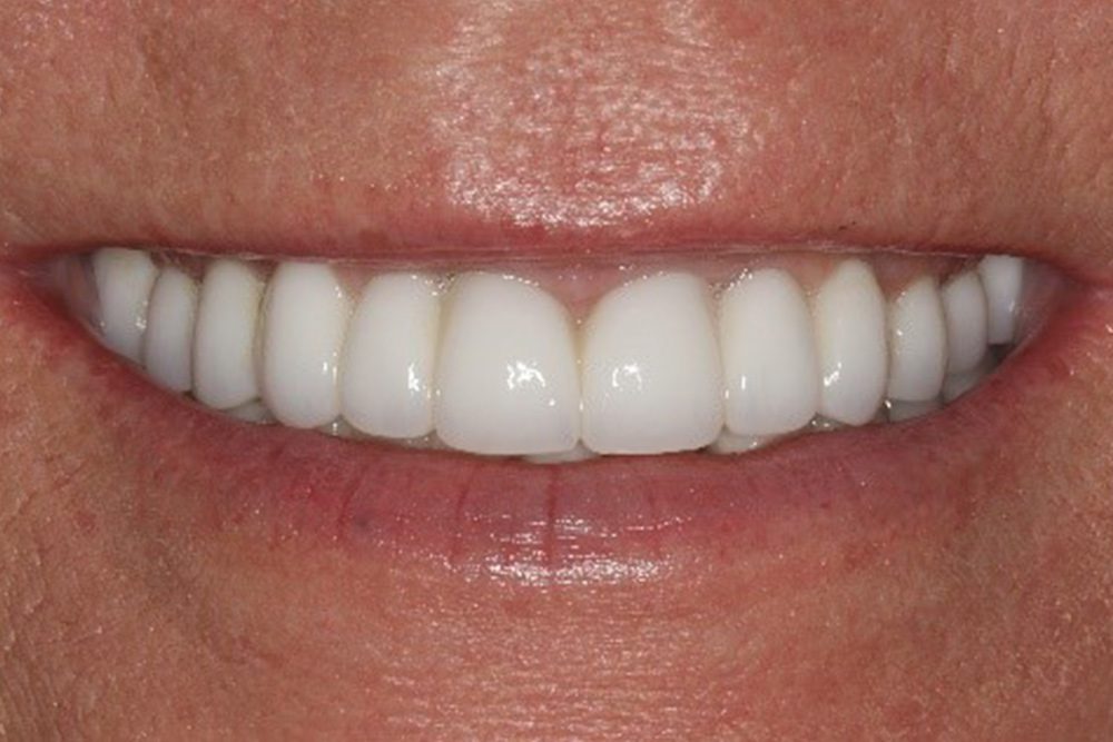 Do Dental Implants Look Like Natural Teeth?