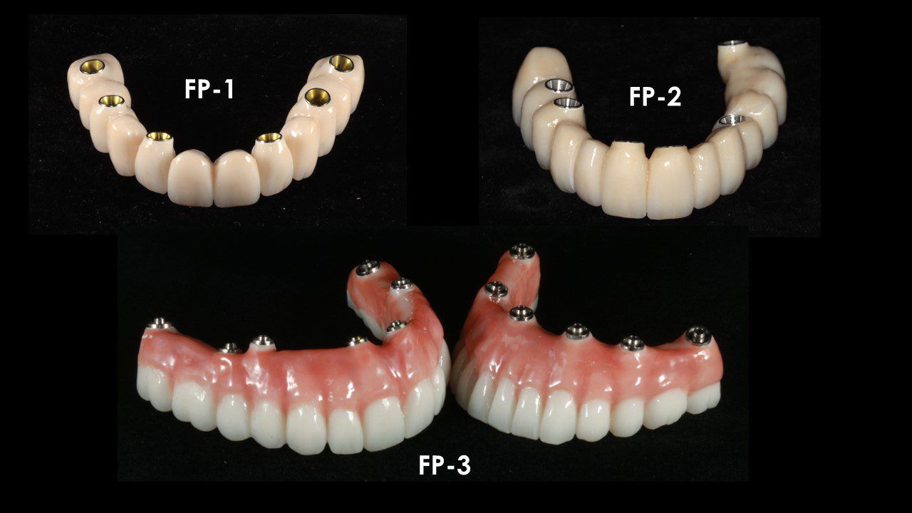 When FP1 and FP2 Implant Bridges Are Better Than All-on-4 - Dental ...