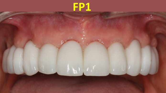 FP1, FP2, and FP3 Dental Prostheses: What’s the Difference? - Dental ...