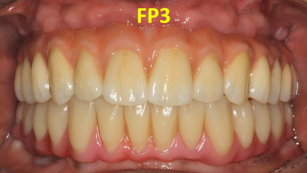 FP1, FP2, and FP3 Dental Prostheses: What’s the Difference? - Dental ...
