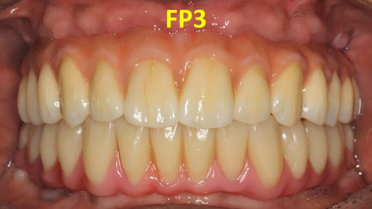 FP1, FP2, and FP3 Dental Prostheses: What’s the Difference? - Dental ...