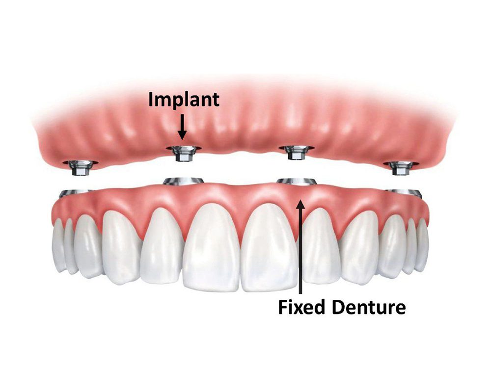 Fixed Dentures - Everything You Need To Know with Pics