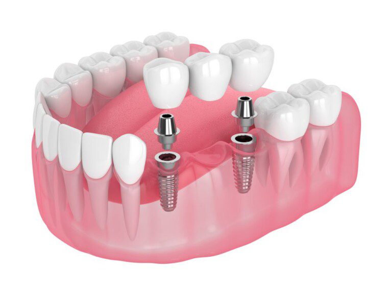 Fixed Bridges vs Fixed Dentures - The Complete Guide
