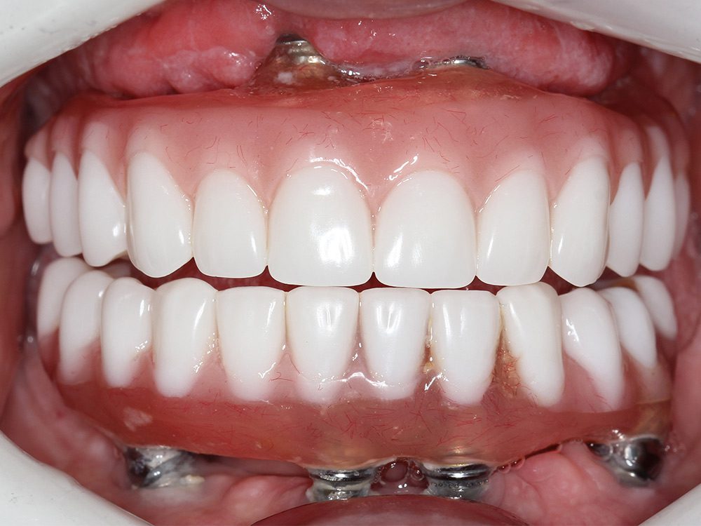 Fixed Bridges vs Fixed Dentures - The Complete Guide