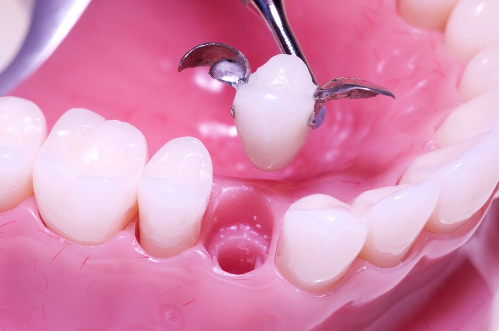 Single Tooth Dental Implant- Costs of Replacement in Dallas TX Single Tooth Dental Implant- Costs of Replacement in Dallas TX