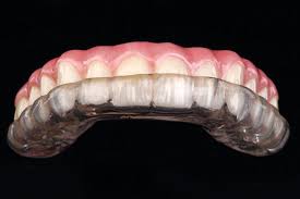 Occlusal Guards - Dental Implant Center