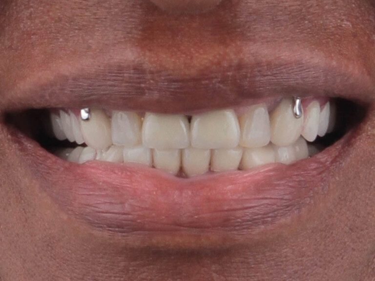 Before and After Partial Dentures - Dental Implant Center