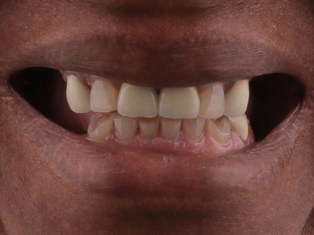 Before and After Partial Dentures - Dental Implant Center