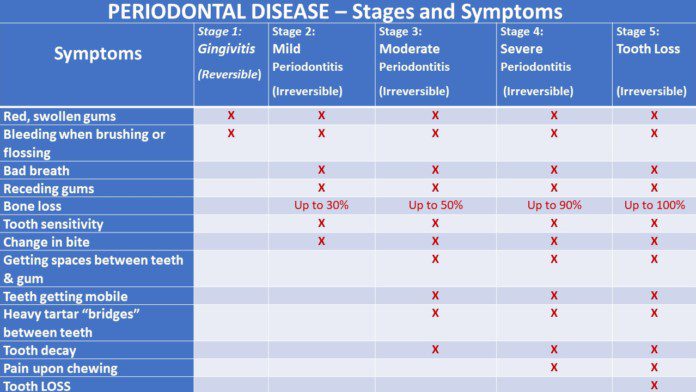 All About Periodontal Disease - Dental Implant Center