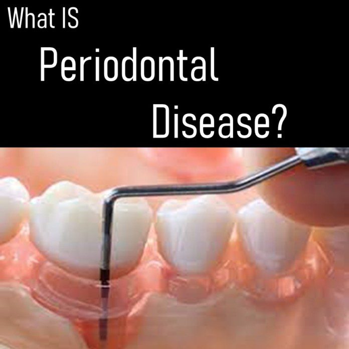 All About Periodontal Disease - Dental Implant Center