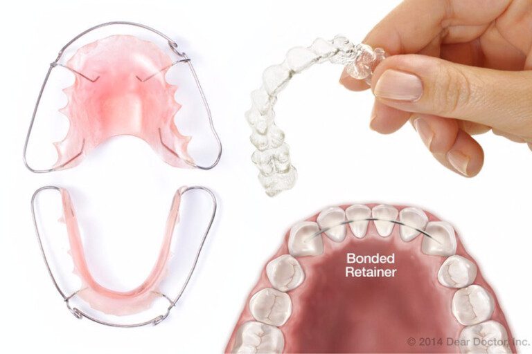 Retainers - Dental Implant Center