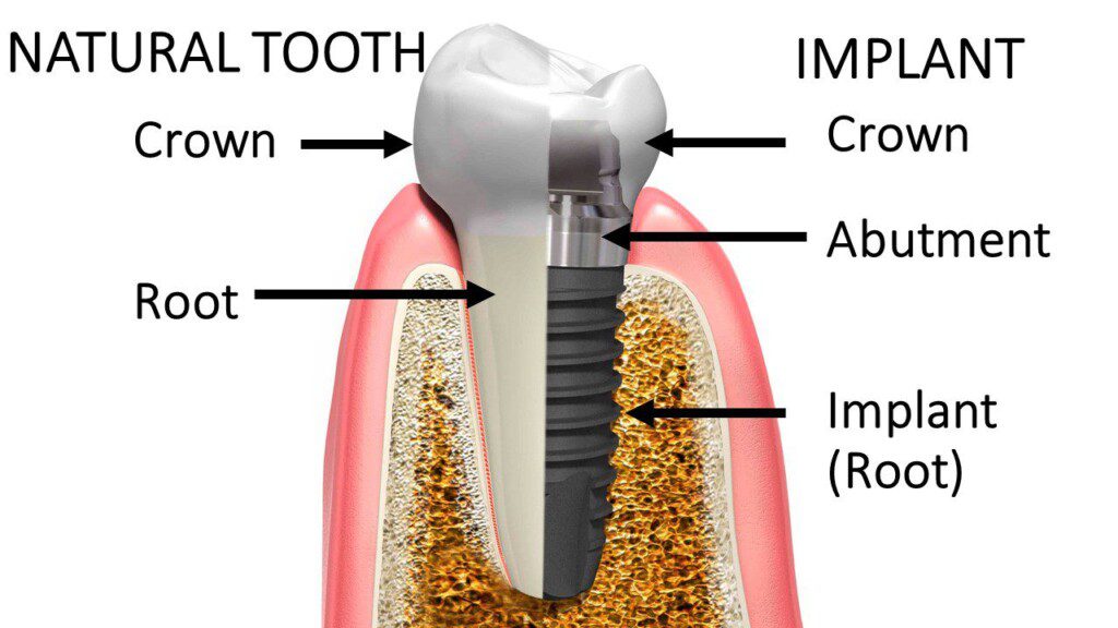 What Are The 3 Stages Of Dental Implants