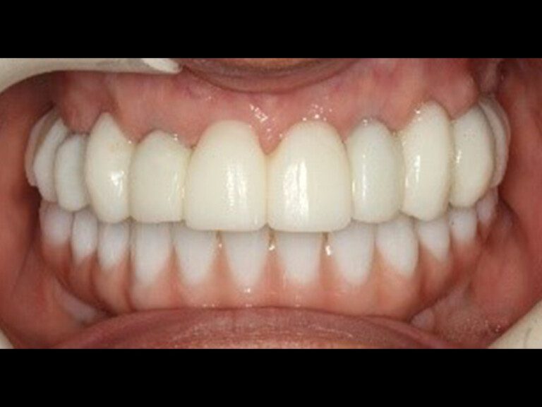 Implant Bridges: What is the process? (with Pics) - Dental Implant Center