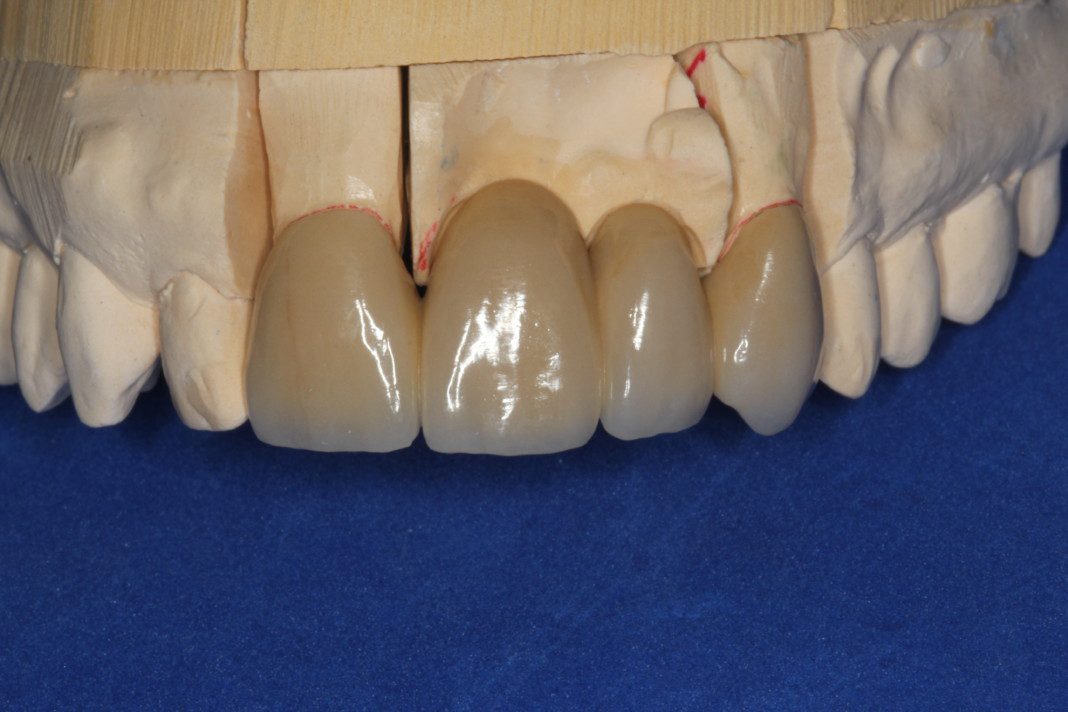 Crowns and Fixed Bridges with Pics - Dental Implant Center