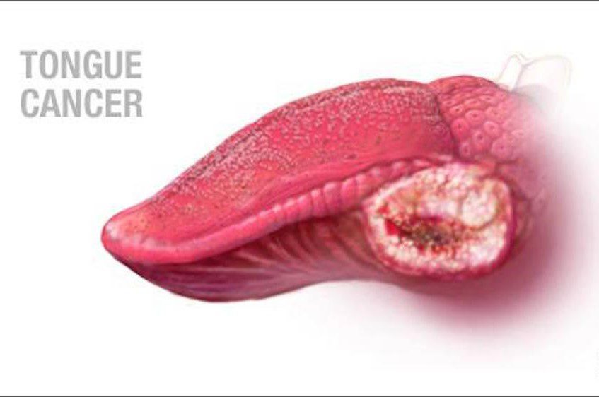 Tongue Cancer - Dental Implant Center