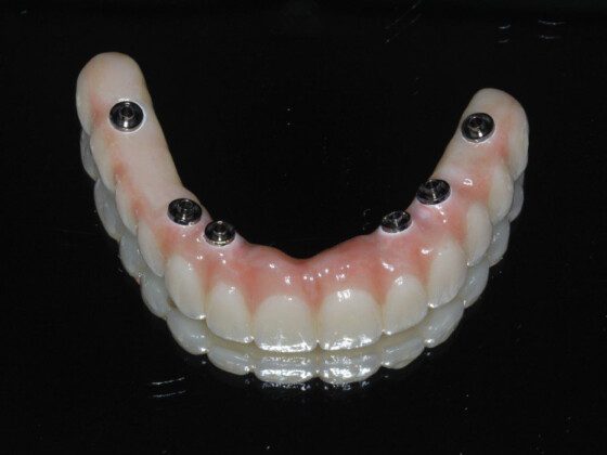 Fixed Dentures - Everything You Need To Know with Pics