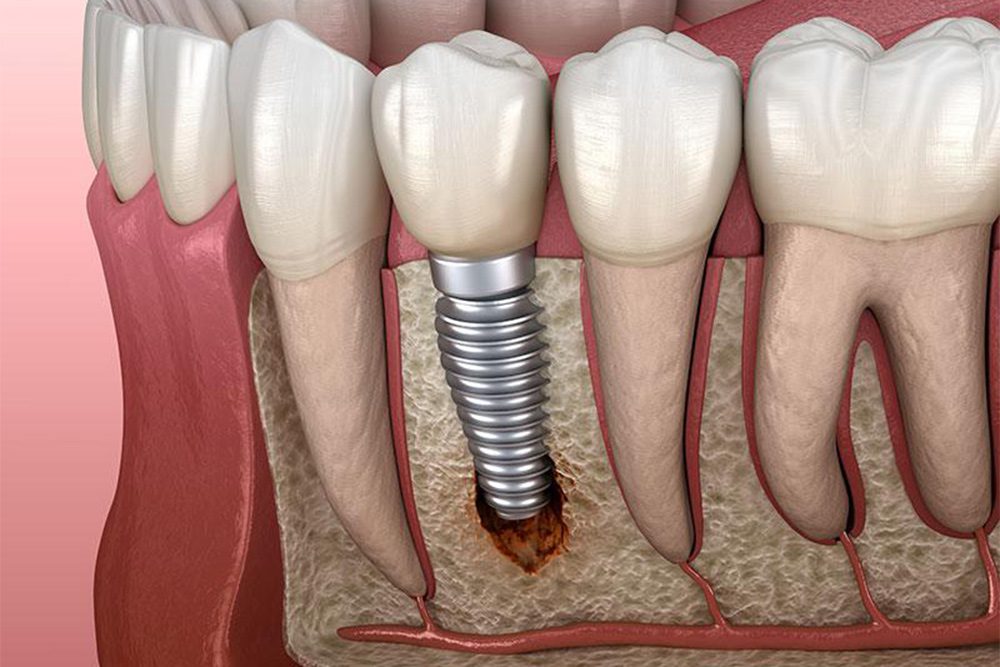 Who Is Responsible for Dental Implant Failure