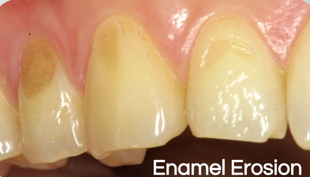 Enamel Erosion - Dental Implant Center